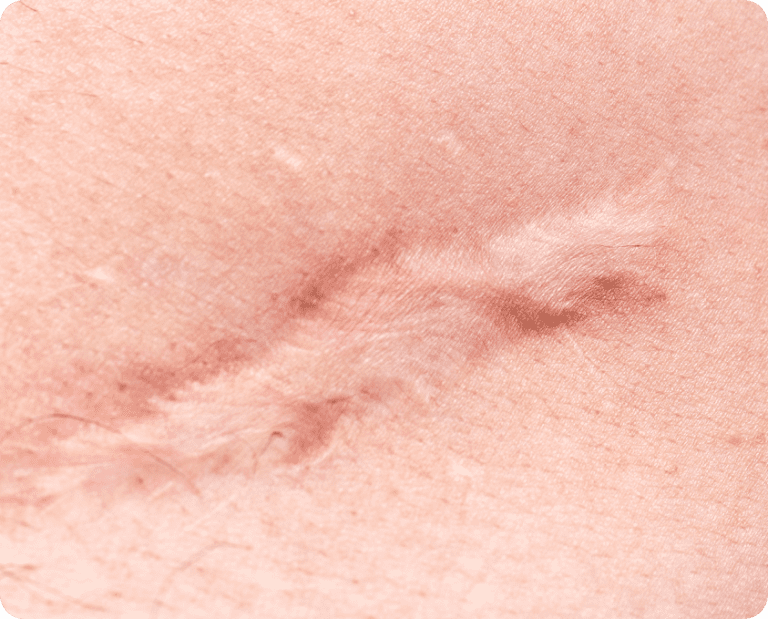 Hypertrophic Scar & Keloid - Ko Skin Specialist